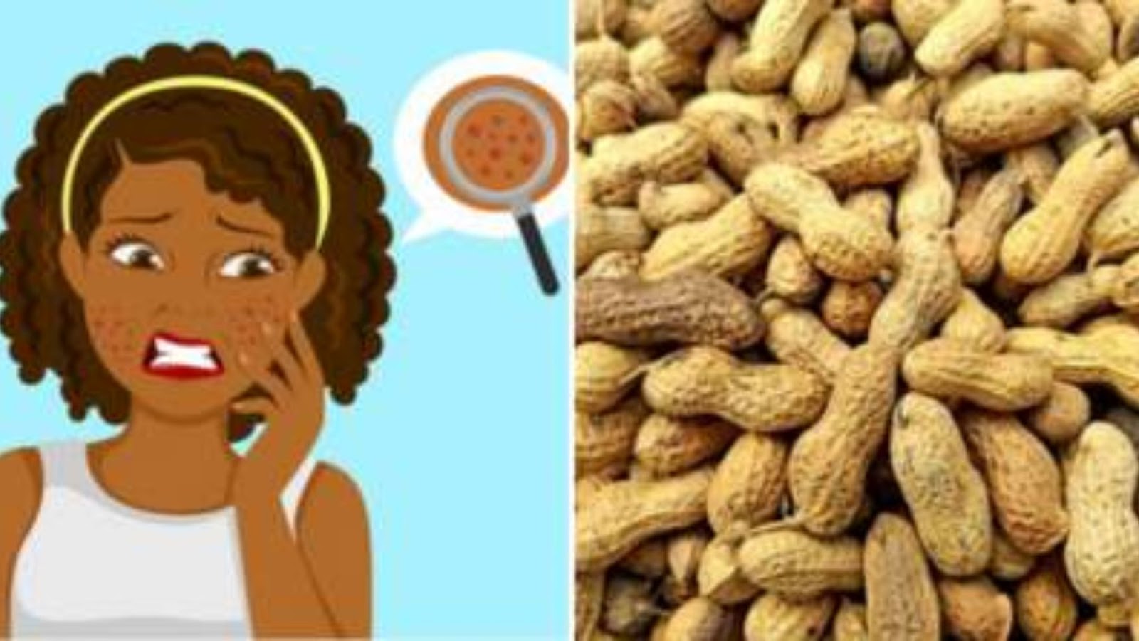 Peanut causes acne: How to avoid it - Fitness Talk